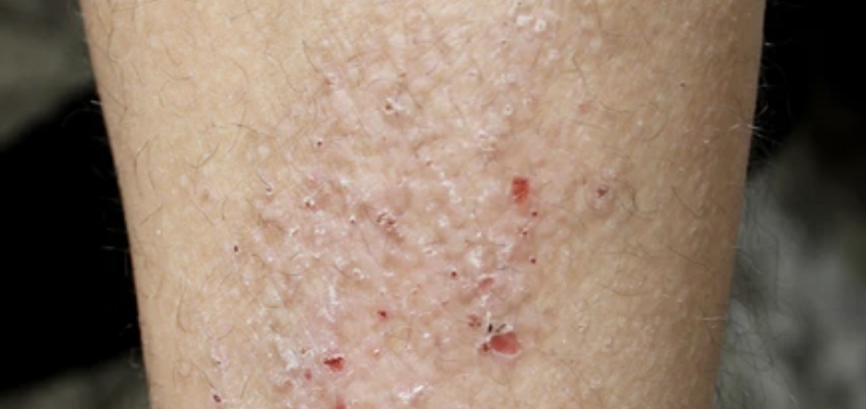 Lichen Simplex - ClearSkin Dermatology Treatment Clinic
